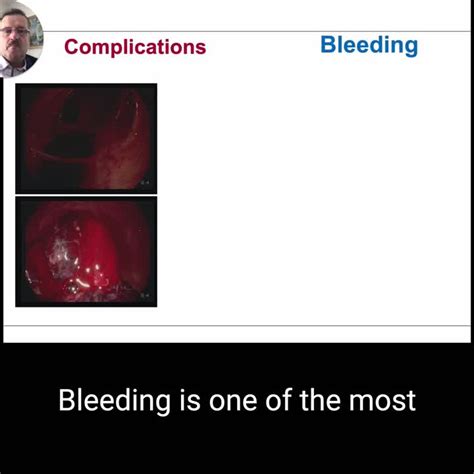 [video] Endocollab™ Gi Endoscopy Education On Linkedin Post Polypectomy Bleeding Tips To