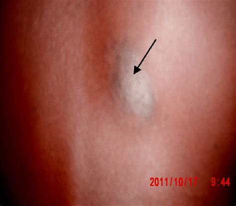 Neurofibroma With Hypertrichosis On The Back Download Scientific Diagram