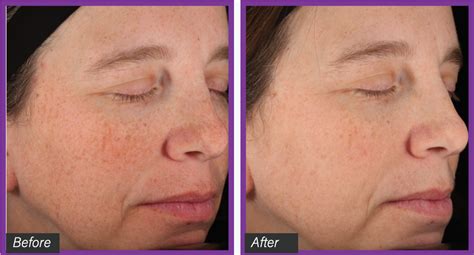 Ultraclear™ Laser Treatment My Face Surgeon