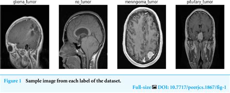 Figure 1 From Advancing Brain Tumor Detection Harnessing The Swin