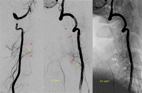 Vertebral Artery Neuroangio Org