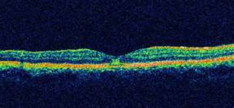 Shows Break In Inner And Outer Segment Of Photoreceptor With