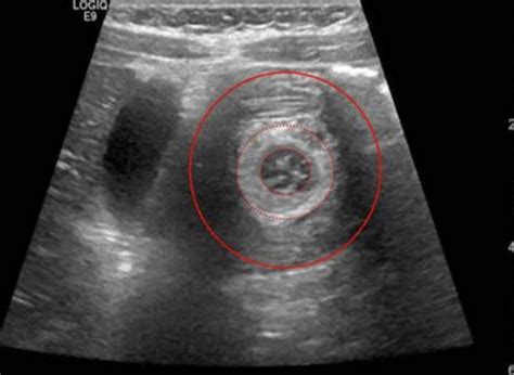 Intussception Flashcards Quizlet