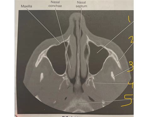 Ct Sinus Axial — Printable Worksheet
