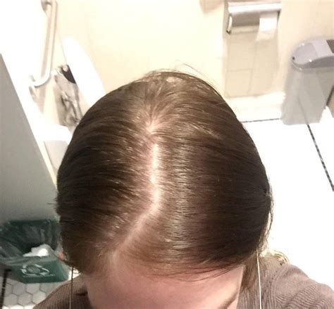 Impacted Wisdom Teeth Causing Sinus Problems Rdentistry