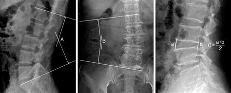 Cobb Method For Measurement Of The Scoliotic Angle A Lordotic Angle Download Scientific