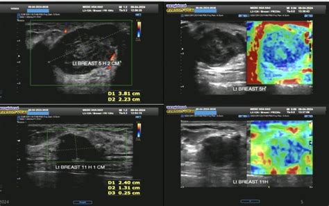 Vietnamese Medic Ultrasound Case 794 795 Phyllodes Tumor Dr Phan