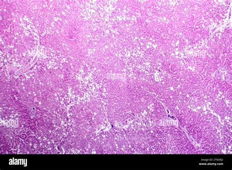 Photomicrograph Of Hepatic Steatosis Revealing Fat Accumulation In Liver Cells Known As Fatty