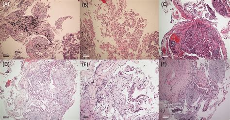 Lung Pathologic Features Of All Six Cases There Were Organizing