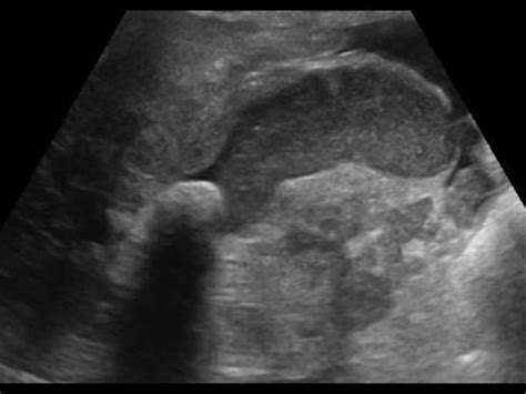 Abdomen And Retroperitoneum 12 Gallbladder And Bile Ducts Case 12