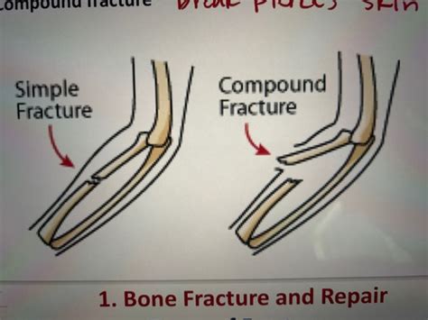 Ch 6c Bone Health And Markings Flashcards Quizlet