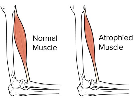 Atrophy Definition Causes Pathogenesis Symptoms And Mcqs For Neet Gpat Csir Net Jrf