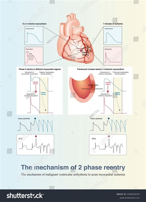 Myocardial Ischemia Fourth Universal Definition Of Myocardial