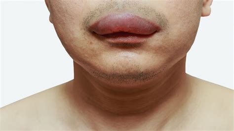 Swollen Upper Lip Causes Symptoms Sudden And Top Lip Swelling