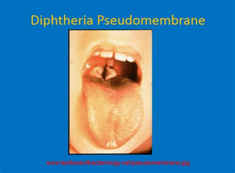 Diphtheria Pseudomembrane