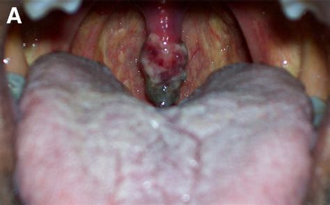 Postendoscopic Retrograde Cholangiopancreatography Uvular Necrosis