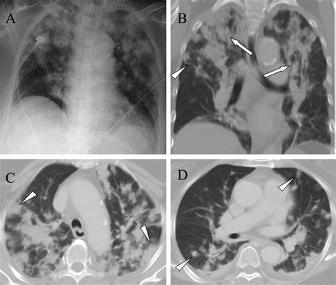 A A Chest Radiograph Reveals Multiple Alveolar Consolidations