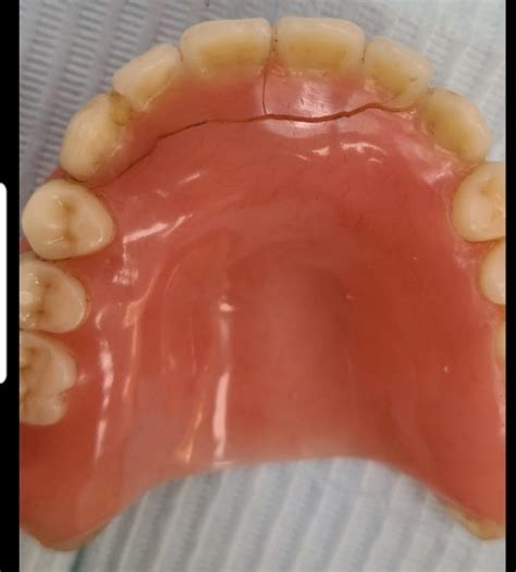 Denture Repair Reline Tooth Addition Rebase One Of Our Useful Services