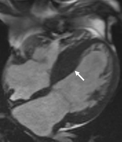 Radiological Detection Of Cardiac Amyloid Mri With Pathological Correlation Applied Radiology
