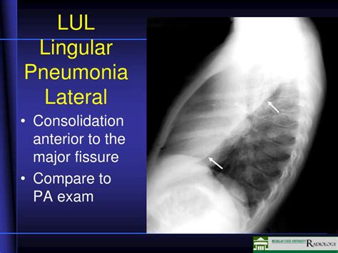 Lingular Pneumonia