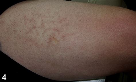 Reticulated Rash On The Anterior Thighs Journal Of The American