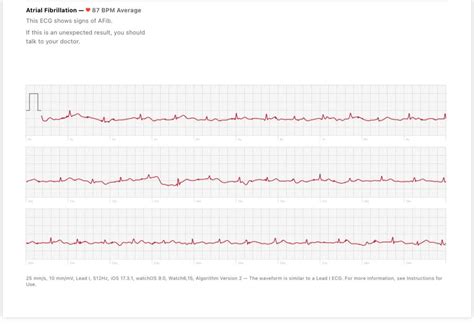 Another Afib Ecg R Afib