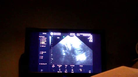 7 Weeks 6 Days Ultrasound Youtube