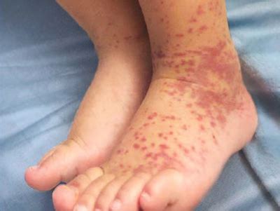 Unusual Rash Clinical Edge Case Ace Qbank
