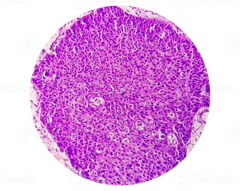 Photomicrograph Showing Tongue Squamous Cell Carcinoma Grade Ii Oral