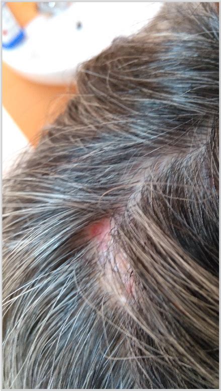 Figure 1 From Erosive Pustular Dermatosis Of The Scalp Semantic Scholar
