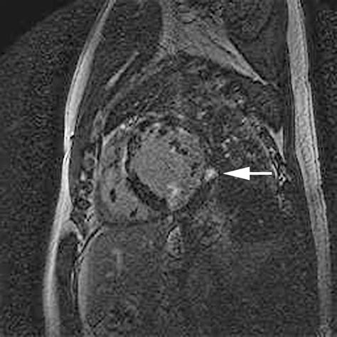 Cardiac Sarcoidosis Heart