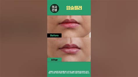 입술필러 전후 💋 자연스러운 입술모양 연신내피부과 Youtube