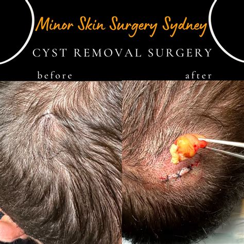 Cyst Surgery Cyst Removal Cyst Treatment Sydney