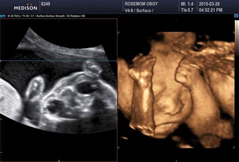 News 초음파 검사에 대하여