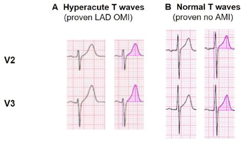 Actually Hyperacute T Waves Can Help Identify Occlusion Mi Journalfeed