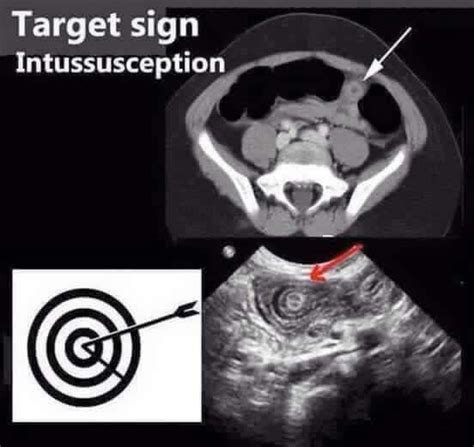 Intussusception Radiology Medical Mnemonics Medical Sign