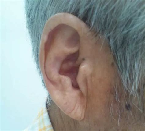 Does A Crease In Your Earlobe Increase Your Risk For Heart Disease