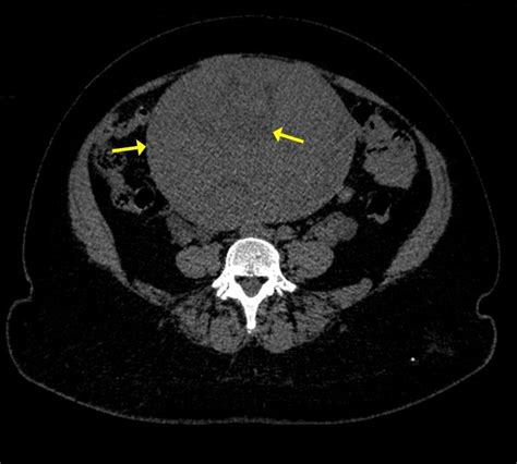 Figure No 1 Ct Scan That Shows Areas Of Necrosis Download