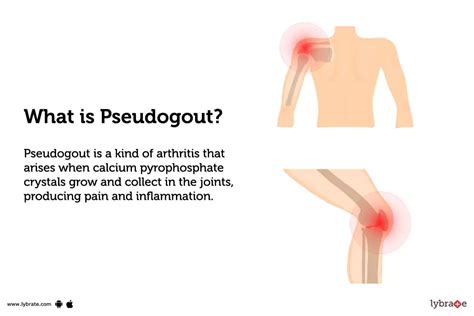 Pseudogout Causes Symptoms Treatment And Cost