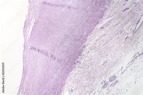 Aortic Atherosclerosis Light Micrograph Photo Under Microscope Stock