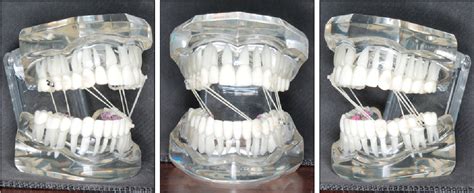 Figure 7 From Skeletal Class Iii Malocclusion With Lateral Open Bite And Facial Asymmetry