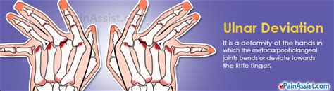 Ulnar Deviation Ulnar Deviation For A Taller Impact Position Youtube
