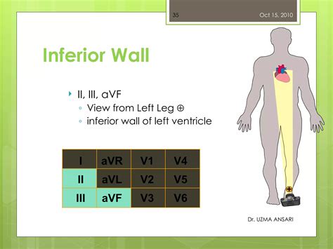Localization Of Mi On Ecg Ppt