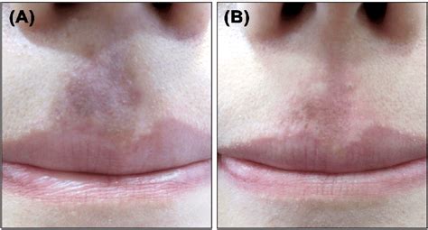 Post Inflammatory Hyperpigmentation In A 20 Year Old Female A
