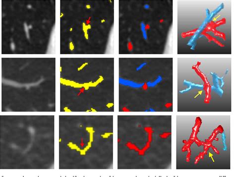 Figure 1 From Automatic Pulmonary Artery Vein Separation And Classification In Computed