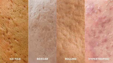 Have You Been Investing Wrongly In Acne Scar Creams Sl Aesthetic Clinic