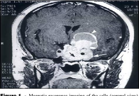Table 1 From The Hook Effect In Prolactin Immunoassays Semantic Scholar
