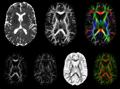 14 Top Row Maps Of The Mean Diffusivity Md Fractional Anisotropy