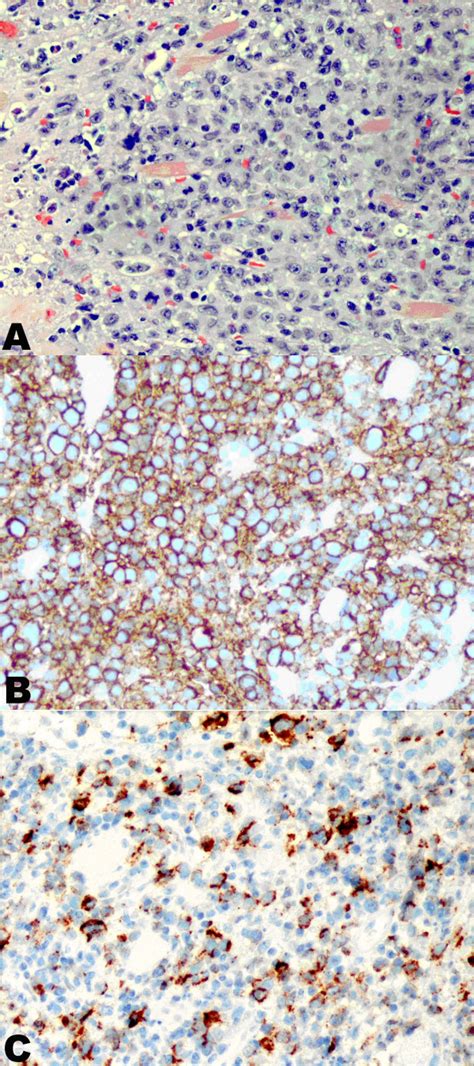 Microphotographs Of The Monomorphic Ptld A Large Lymphoid Cells With