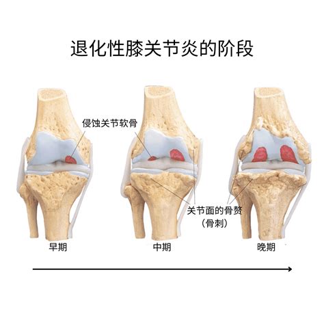 关节退化 关节炎 关节痛 香港港安医院司徒拔道